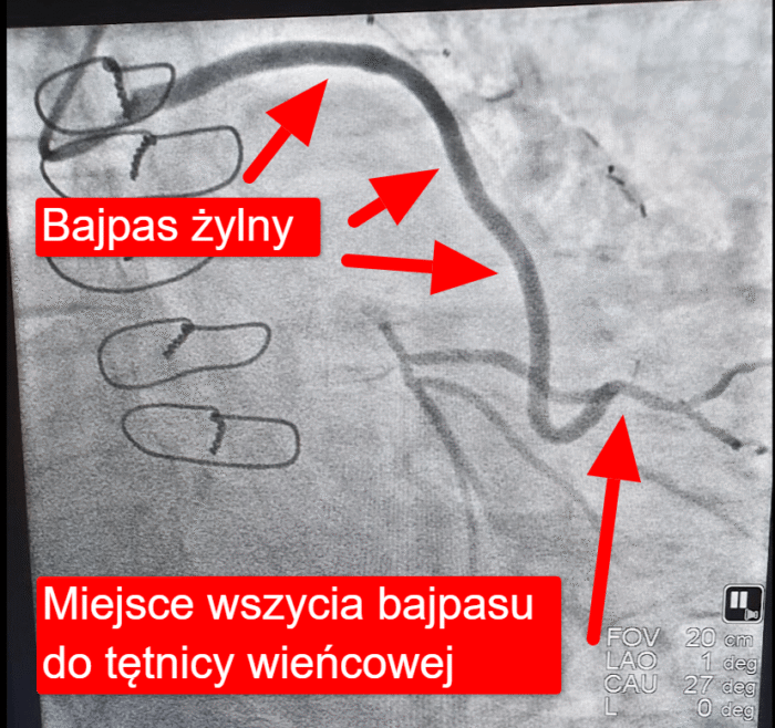 Co to są bajpasy? - Dr n. med. Tomasz Jeżewski